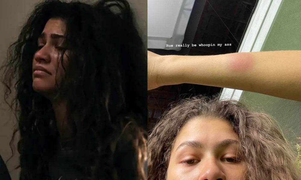 Zendaya still has physical scars from Euphoria intervention episode