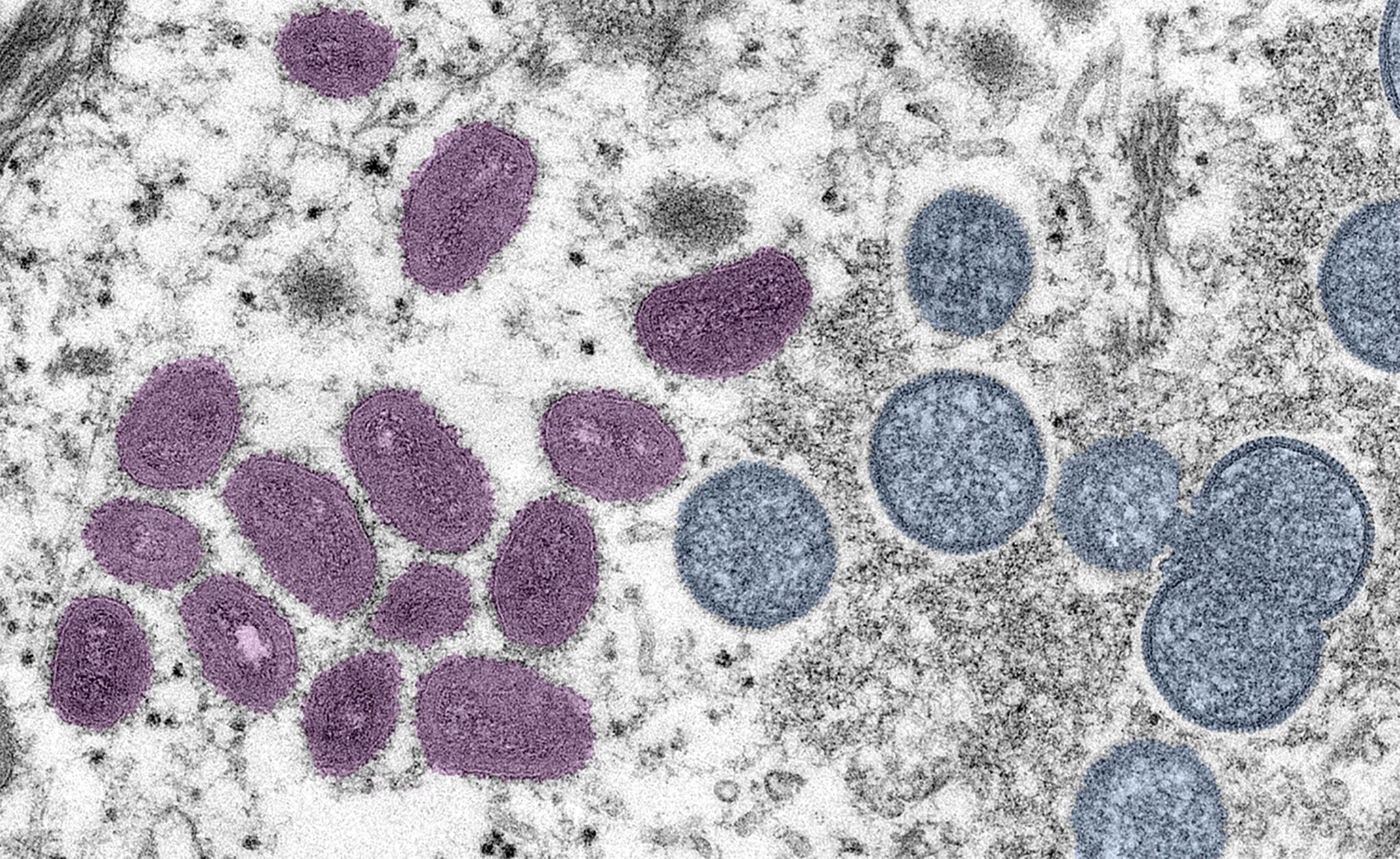 New monkeypox symptoms announced by UKHSA