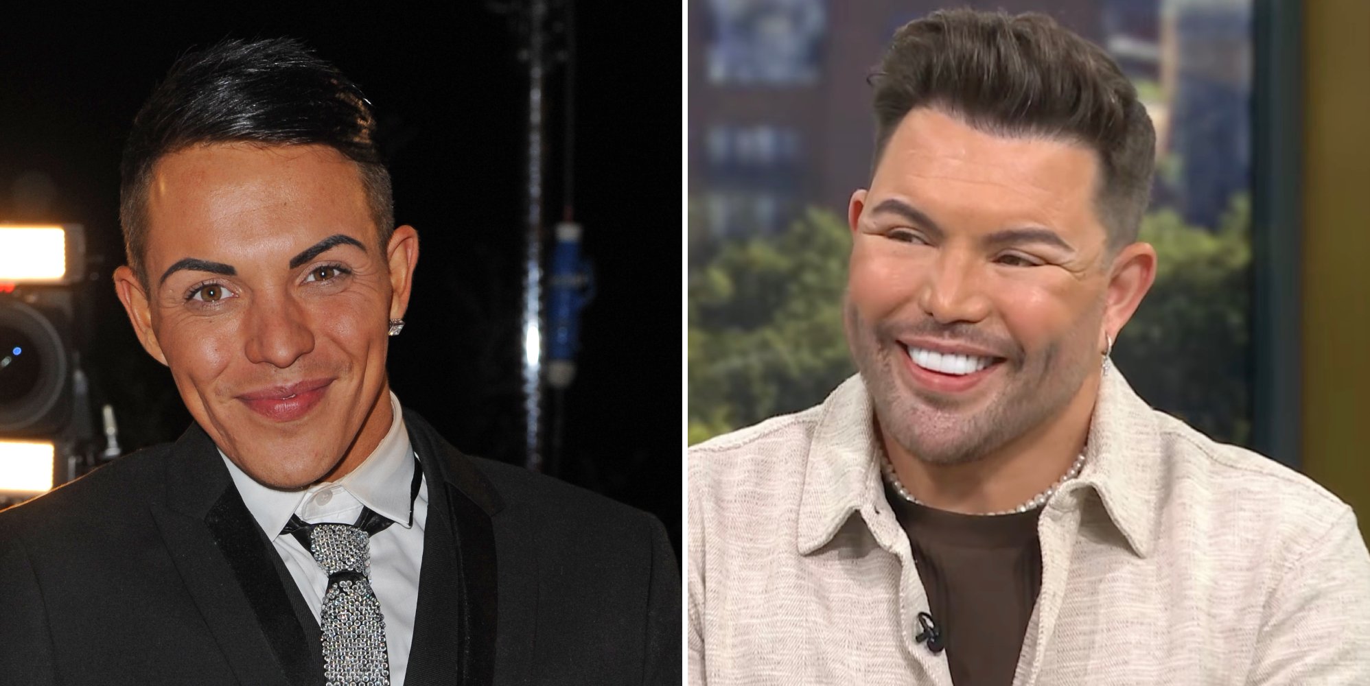 TOWIE star Bobby Norris unveils facelift after 'abusing fillers'